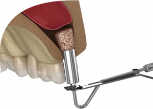 Sinus Lift – Pacific